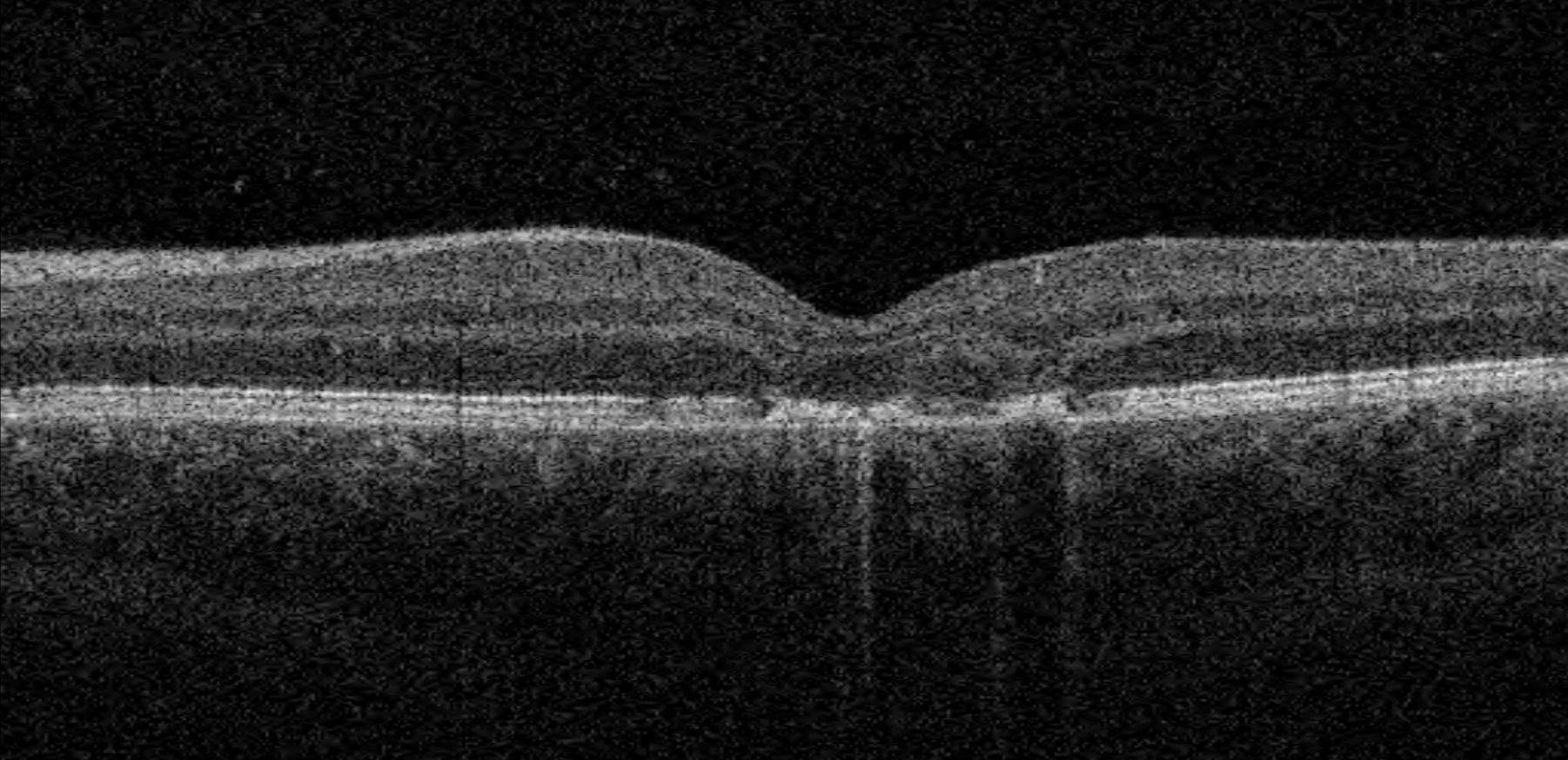 Foveal laser pointer injury: are laser pointers safe enough for public ...