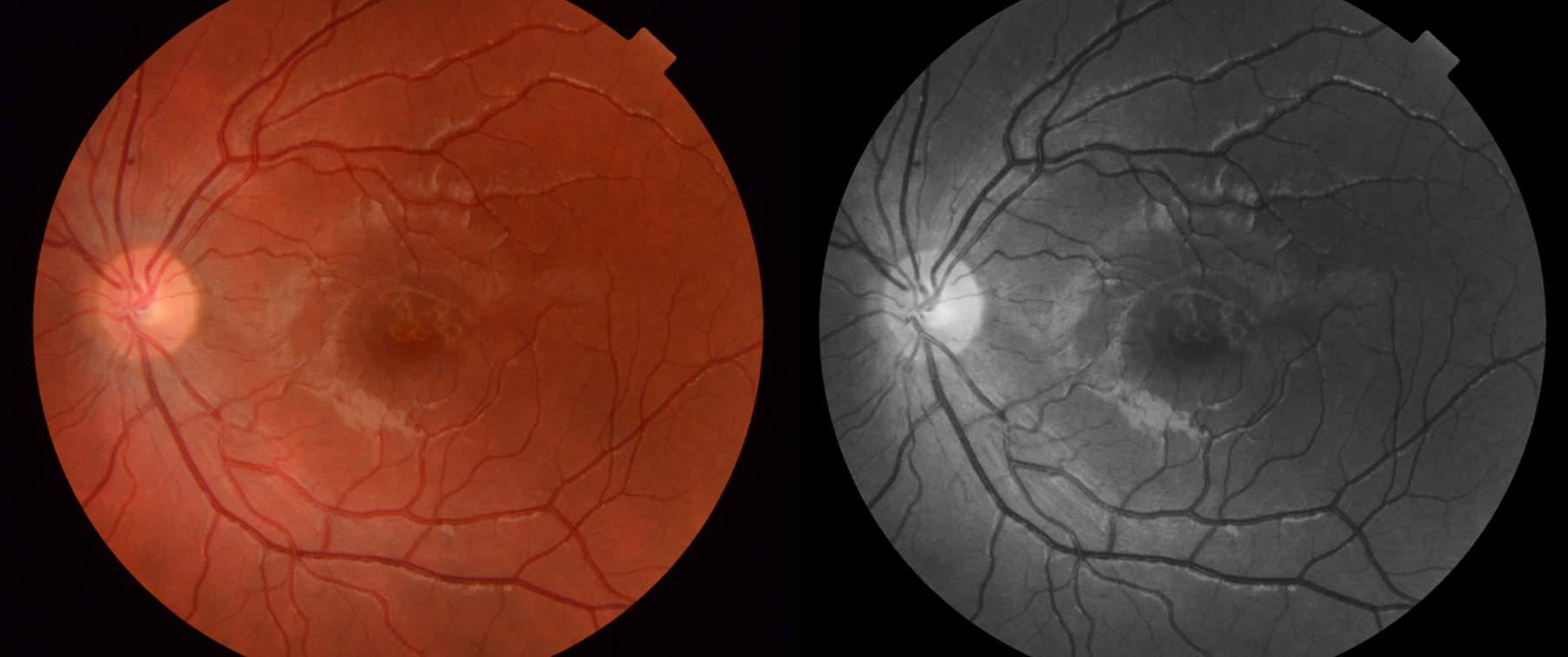 Foveal laser pointer injury: are laser pointers safe enough for public ...