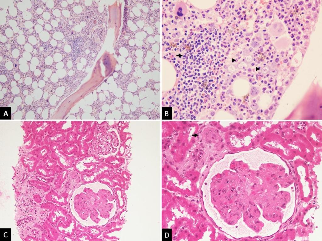 Parvovirus-related anaemia and thrombotic microangiopathy in a renal ...