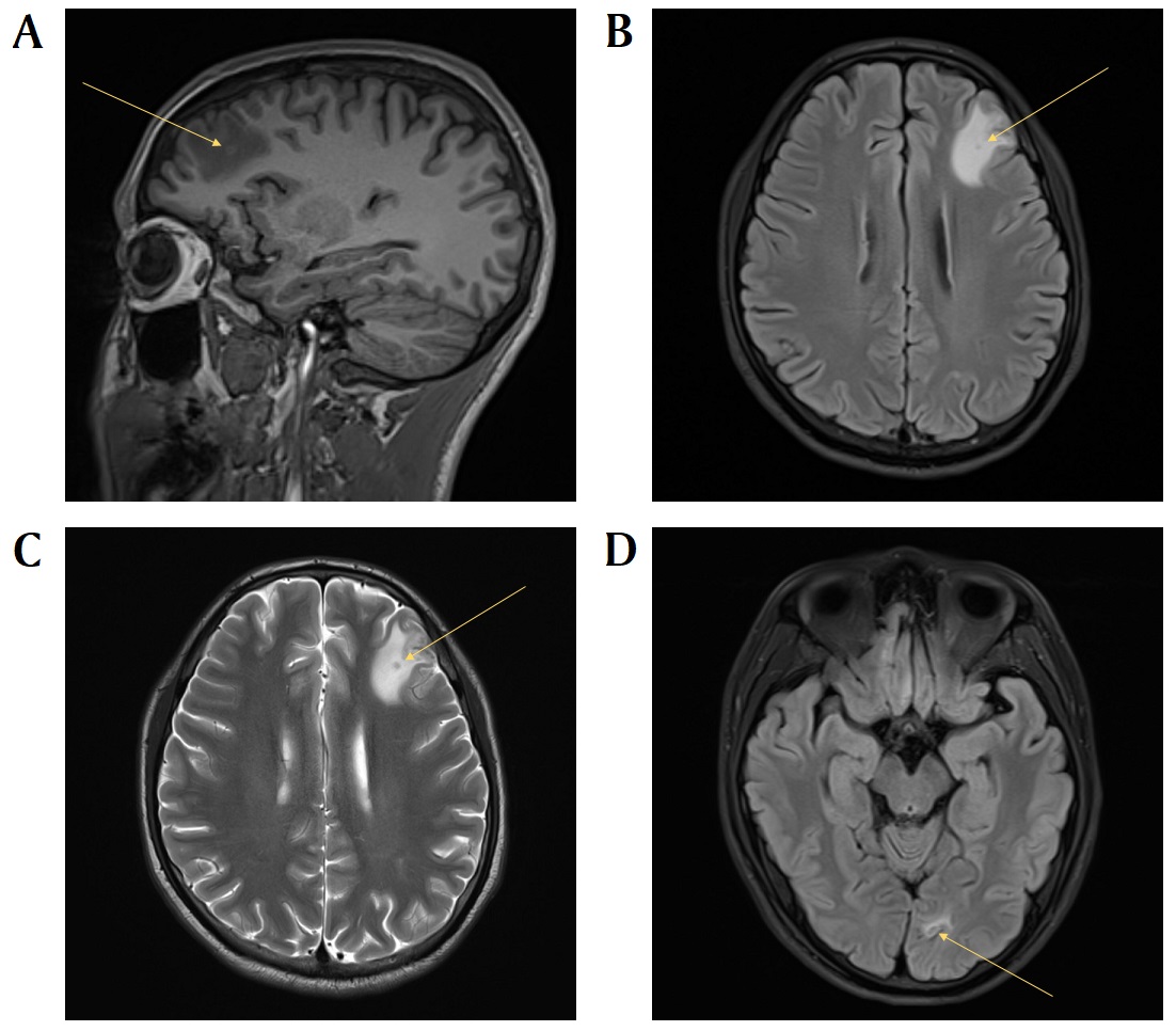 An unexpected case of disseminated tuberculosis from tumour necrosis ...