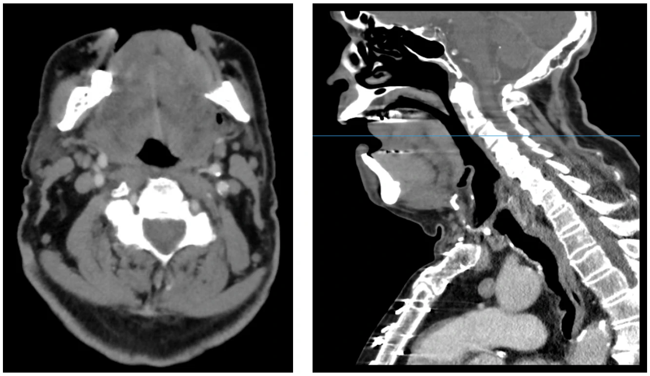 Spontaneous atraumatic lingual haematoma presenting with threatened ...