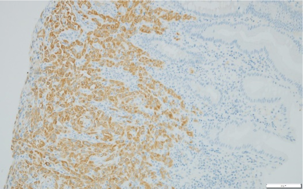 Diagnosis of metastatic lung cancer from a colonic polyp: case report ...