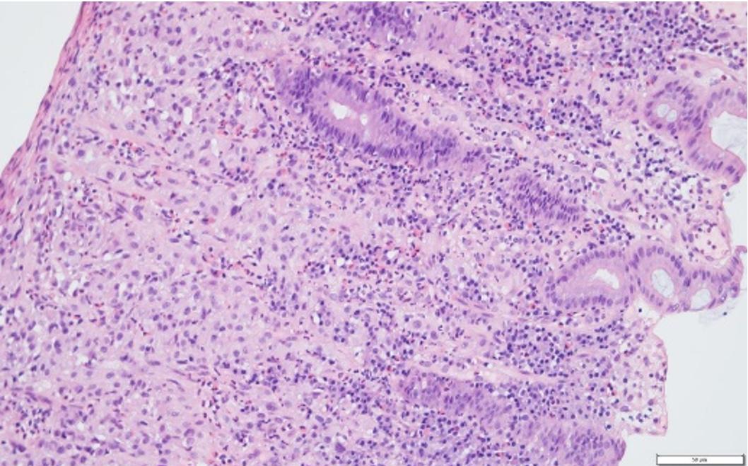 Diagnosis of metastatic lung cancer from a colonic polyp: case report ...