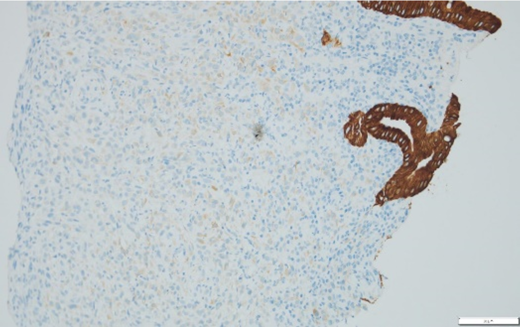 Diagnosis of metastatic lung cancer from a colonic polyp: case report ...