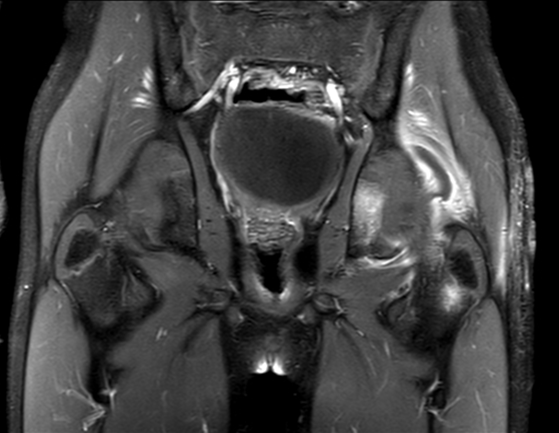Co-infection of influenza A with Staphylococcus aureus causing ...