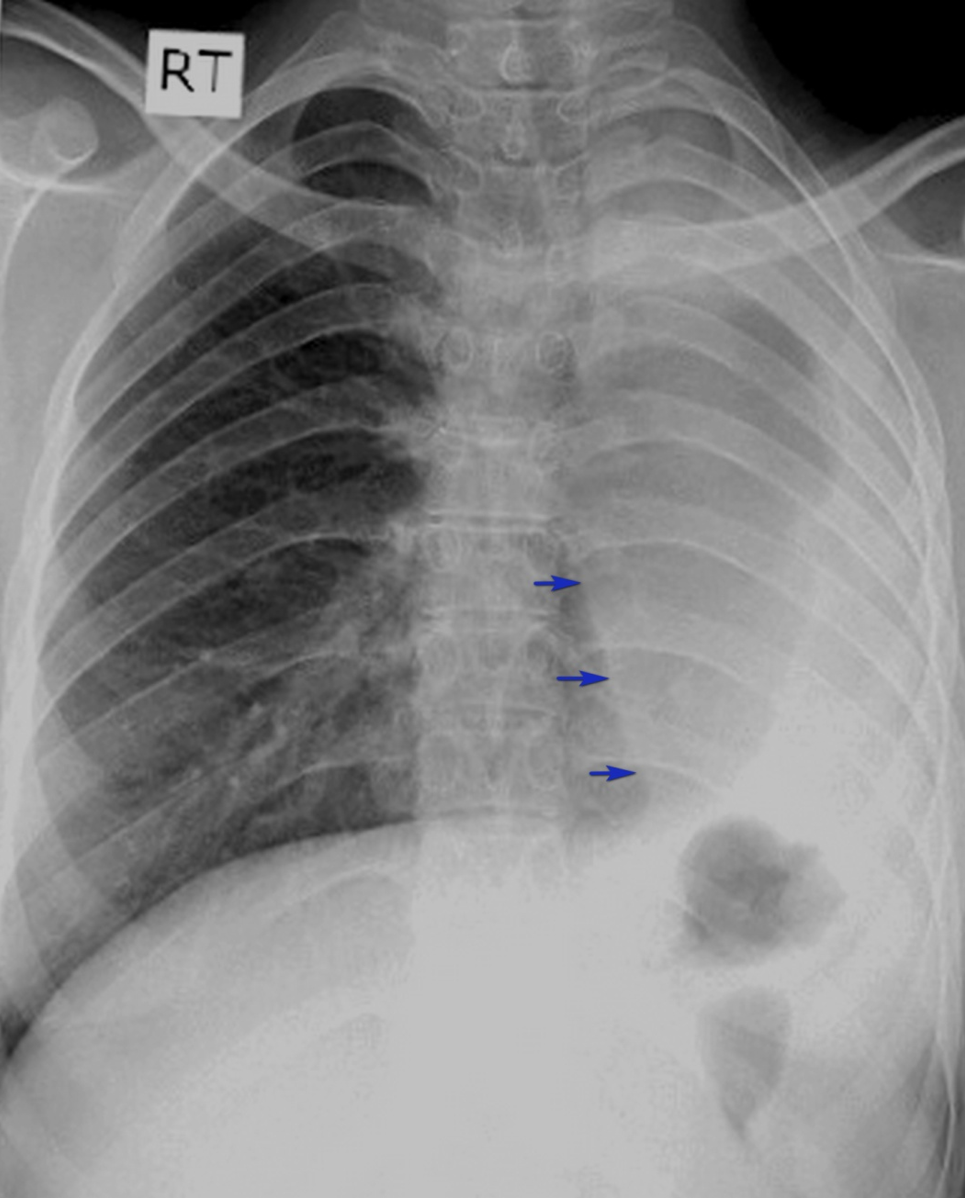 Unilateral pulmonary opacity with herniation of contralateral lung to ...