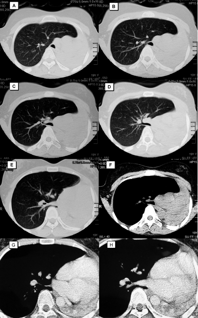 Unilateral pulmonary opacity with herniation of contralateral lung to ...