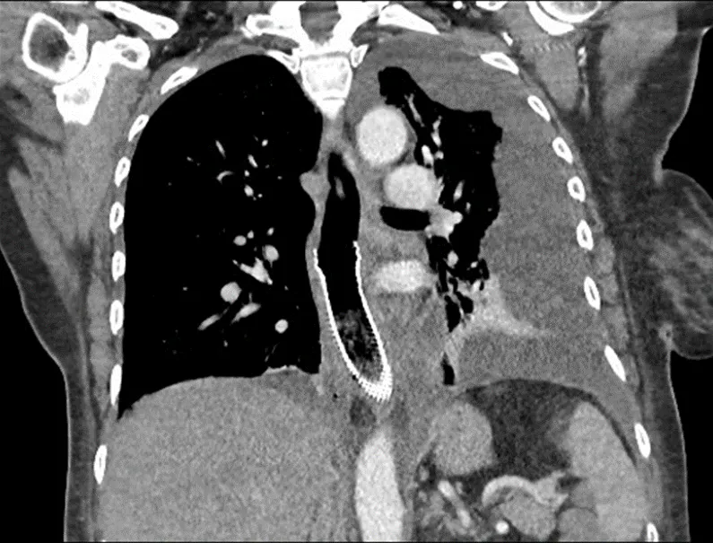Oesophageal rupture presenting as upper gastrointestinal bleed - The ...