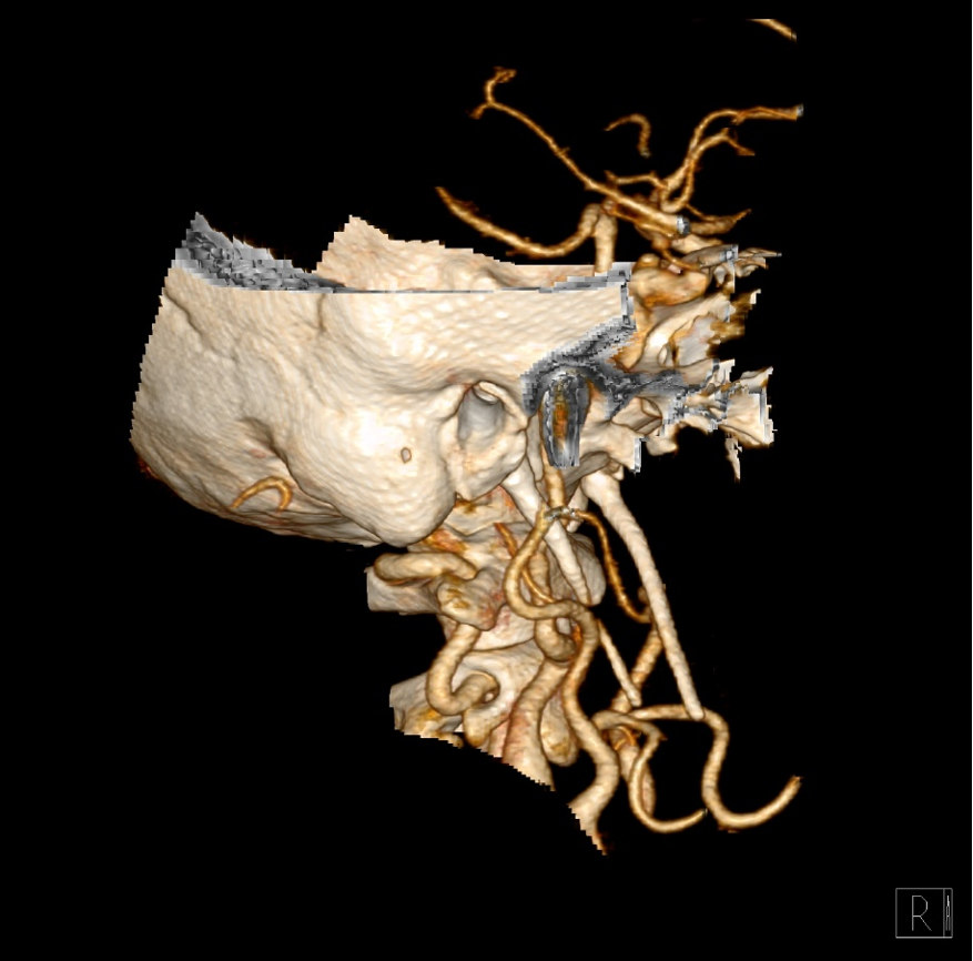 A rare presentation of Eagle syndrome - The New Zealand Medical Journal