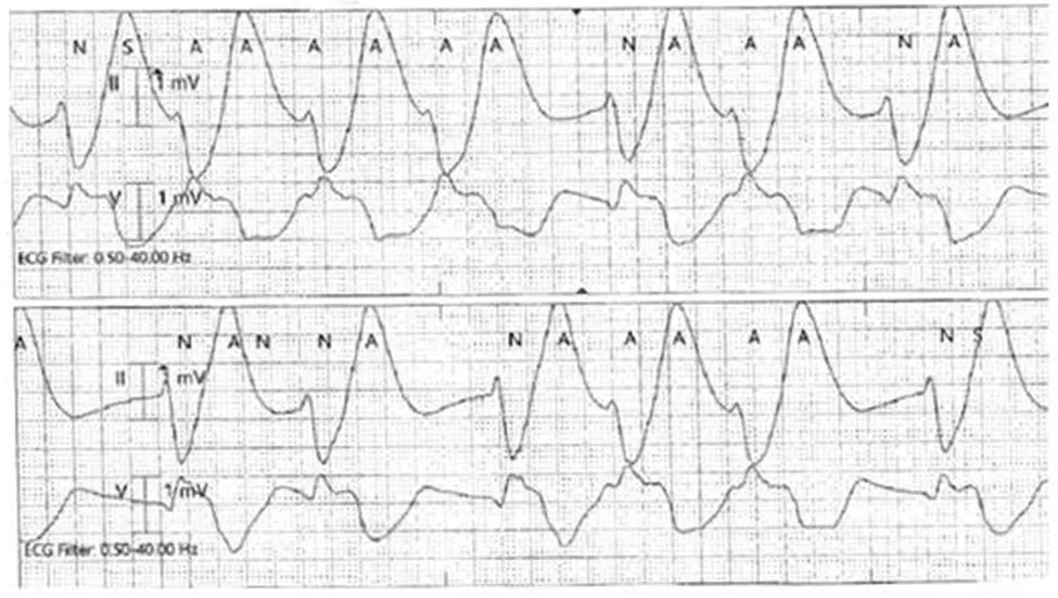 More than merely potassium: an uncommon cause for sine waves in renal ...