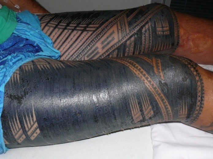 Blood brothers: tattoo sepsis in two Samoan men - The New Zealand ...