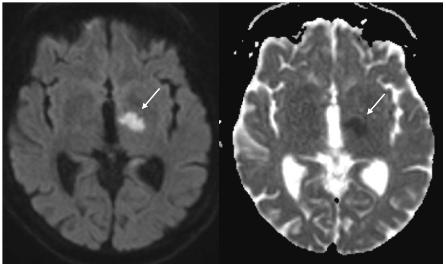 Early neurological deterioration after ischaemic stroke due to cardiac ...