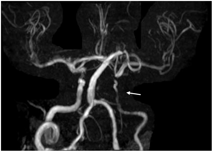 Early neurological deterioration after ischaemic stroke due to cardiac ...