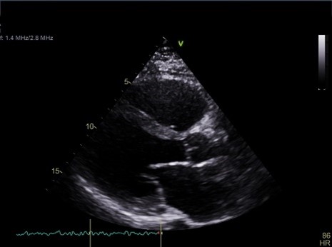 Cobalt toxicity: a preventable and treatable cause for possibly life ...
