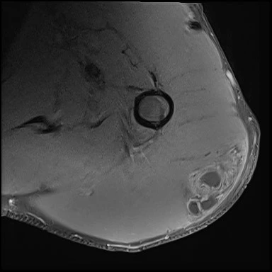 Apricot oil as a cause for multi-lobulated oil cysts in the deltoid ...