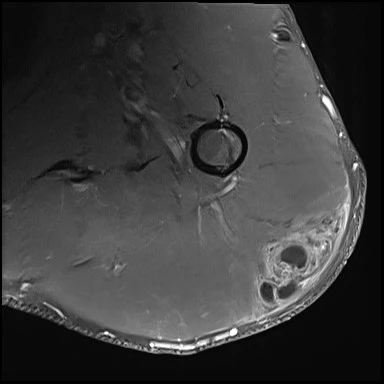 Apricot oil as a cause for multi-lobulated oil cysts in the deltoid ...