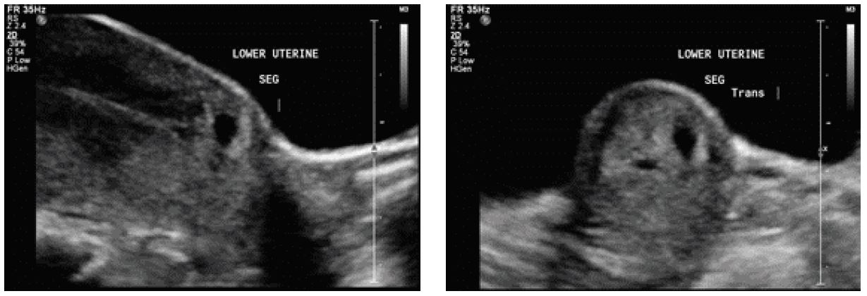 Caesarean scar ectopic pregnancy: a case series and case report to ...