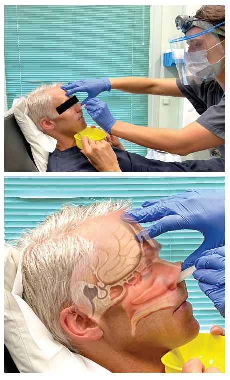 Cerebrospinal fluid rhinorrhoea following nasal packing for epistaxis ...