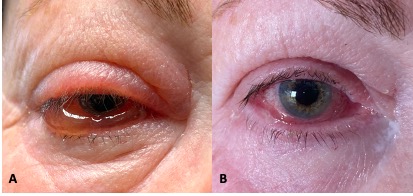 Zoledronate-induced anterior uveitis, scleritis and optic neuritis: a ...