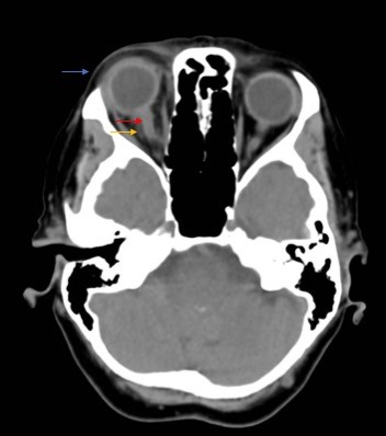 Zoledronate-induced anterior uveitis, scleritis and optic neuritis: a ...