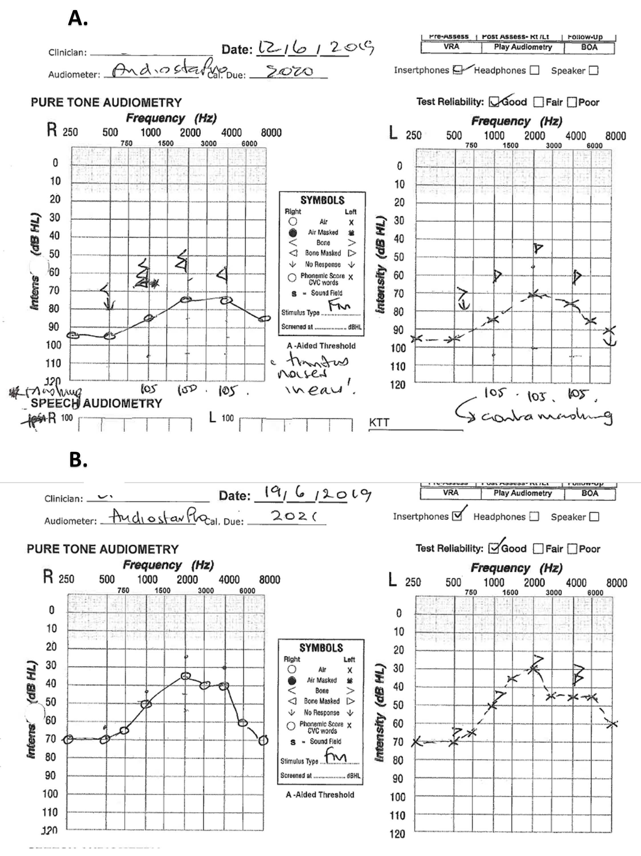 Multiple cranial neuropathies as the initial presentation of EBV ...