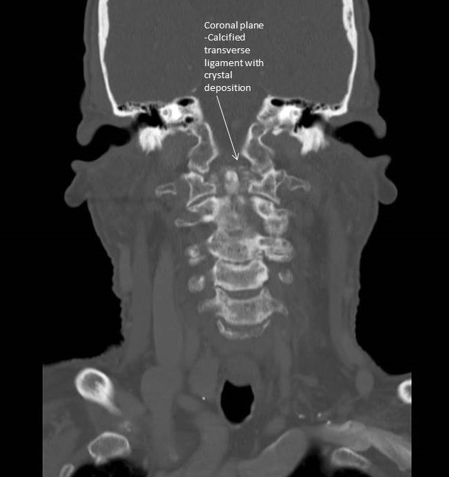 Crowned dens syndrome: a key differential for acute neck pain in the ...