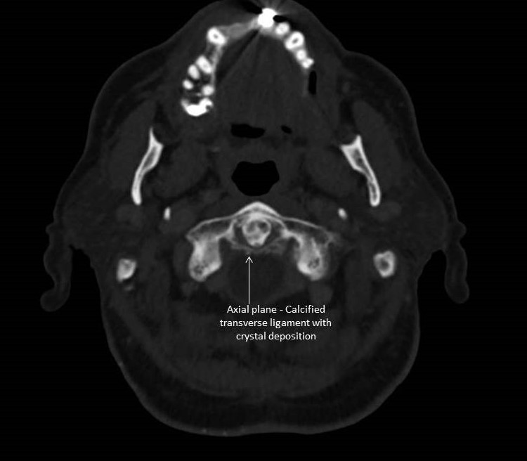 Crowned dens syndrome: a key differential for acute neck pain in the ...