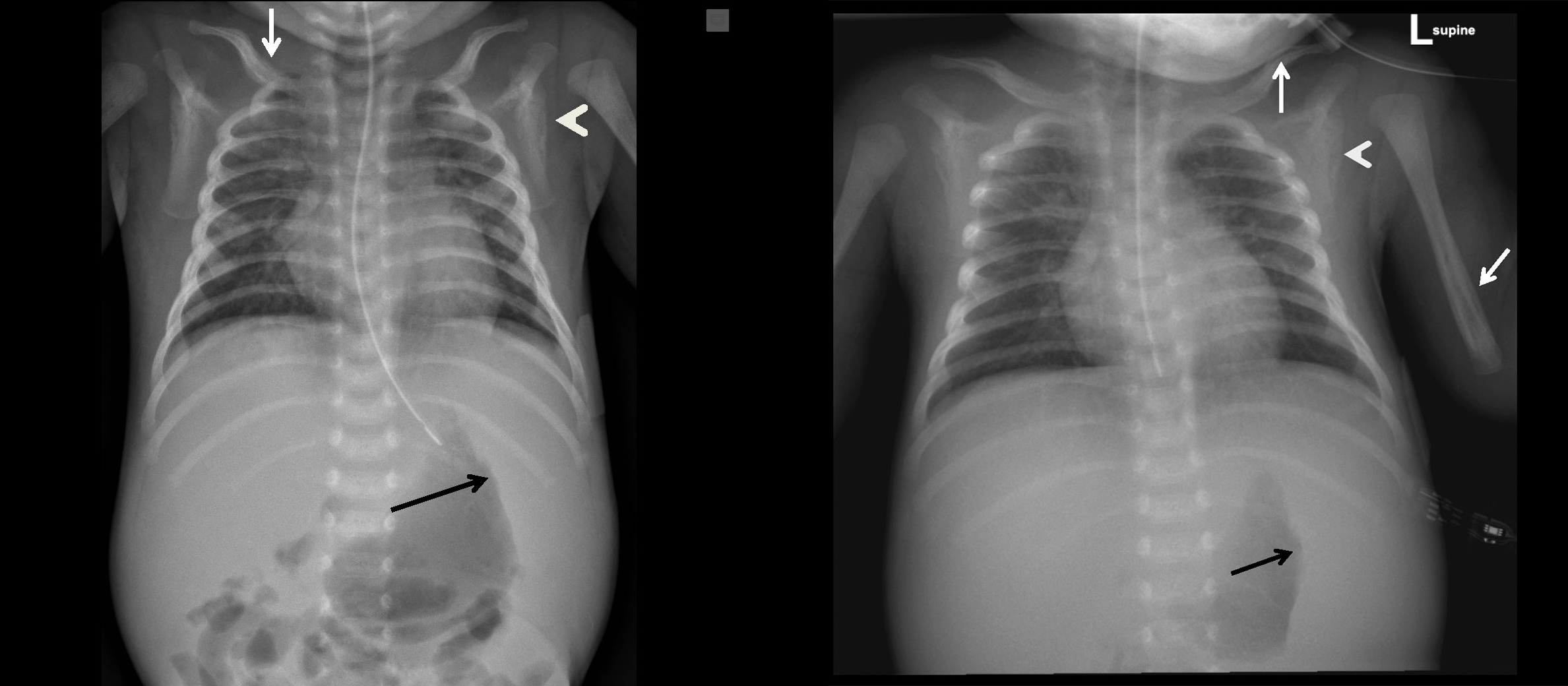 A case of congenital syphilis: the alarming and inequitable rise in ...