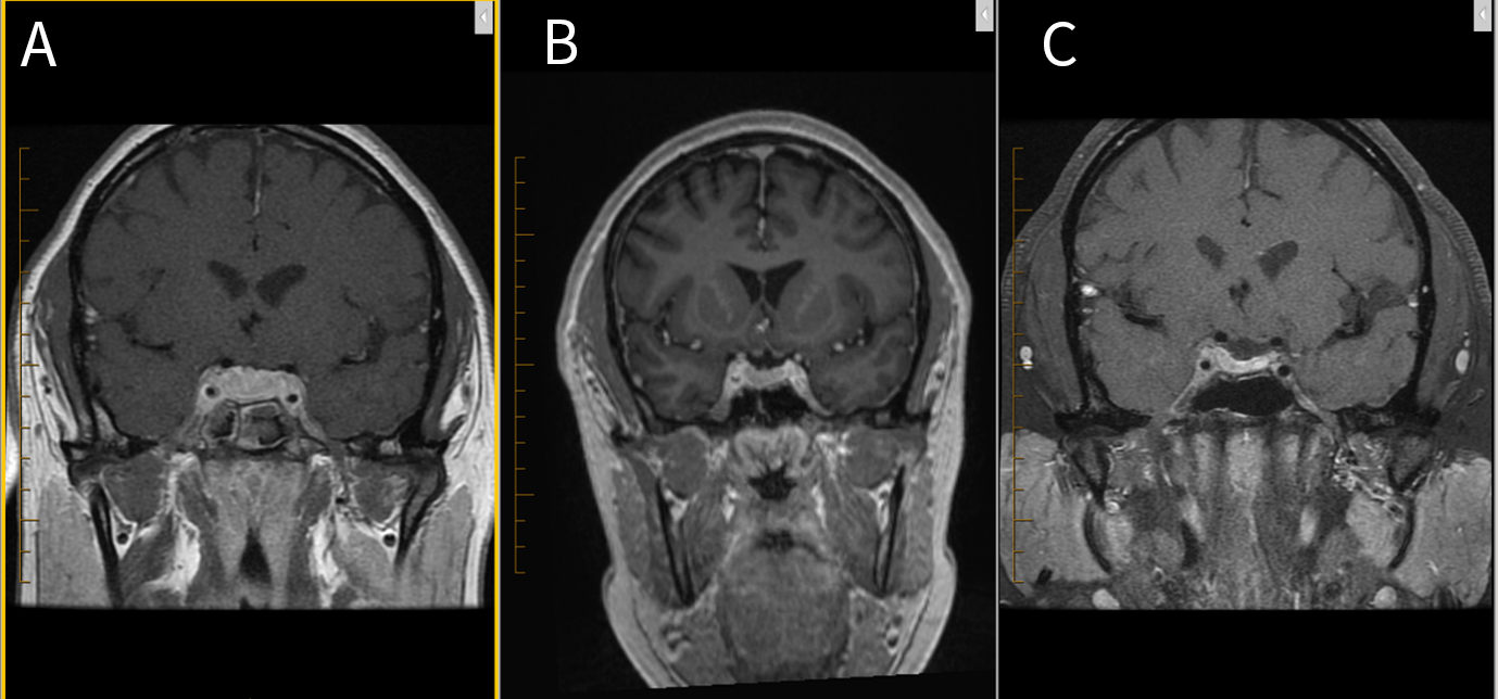 From left to right: an unusual presentation of Tolosa-Hunt syndrome ...