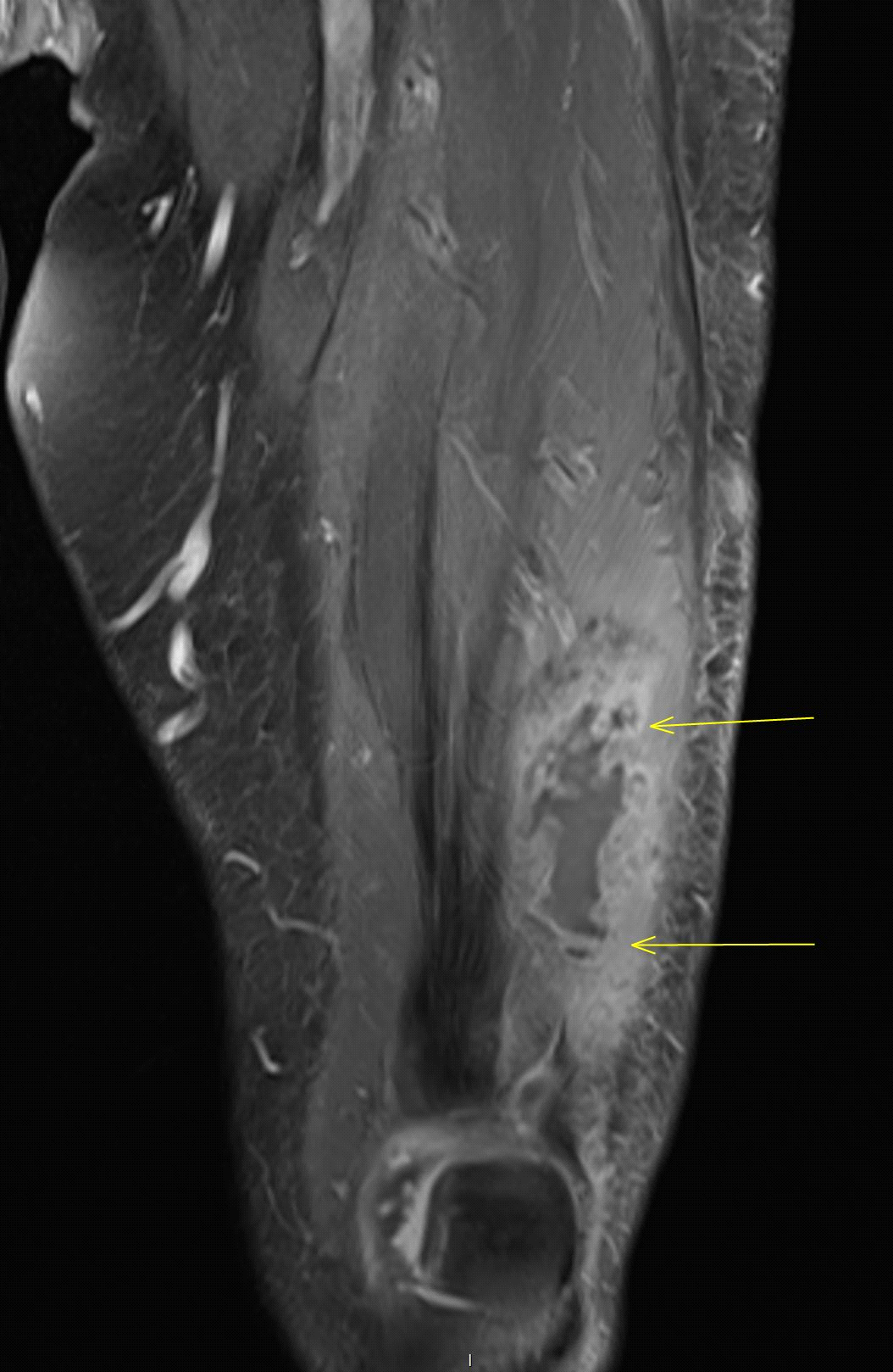 Diabetic myonecrosis presenting as unilateral thigh pain and swelling ...