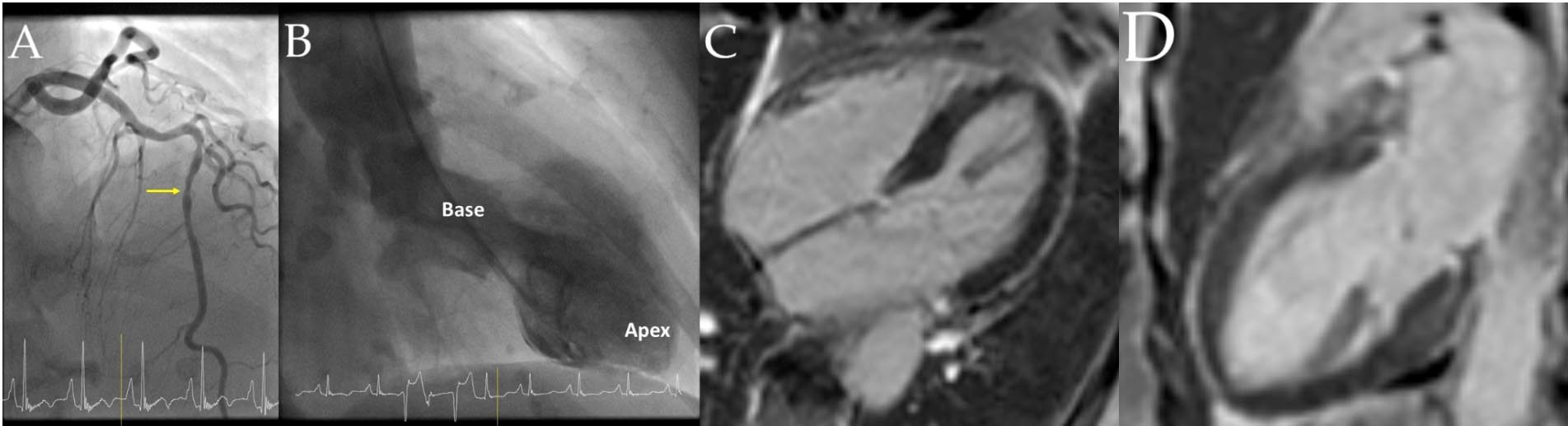 Cardiac magnetic resonance imaging can identify a diagnosis in ...