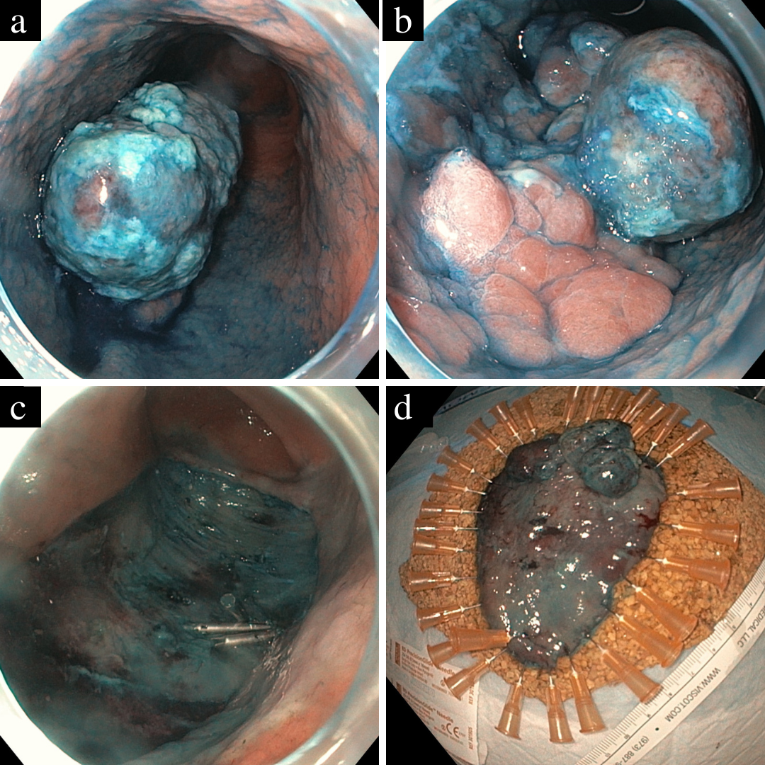 Endoscopic submucosal dissection: the first reported experience from a ...