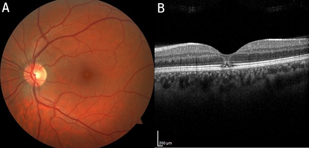 Solar maculopathy and dissociative symptoms: a case report on a patient ...