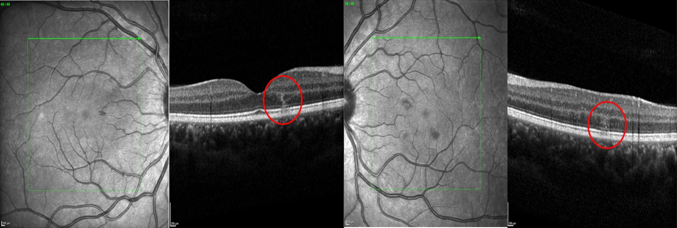 Acute macular neuroretinopathy following COVID-19 infection - The New ...